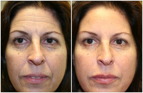 Botox - Michigan Cosmetic Surgery - Breast Augmentation