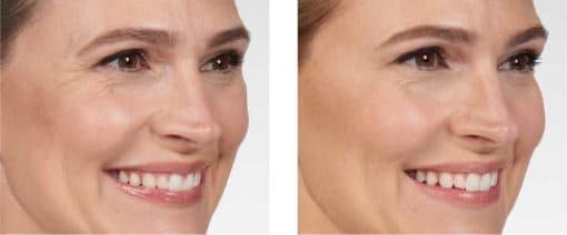 Botox - Michigan Cosmetic Surgery - Breast Augmentation